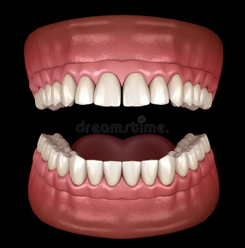 Maxillary and Mandibular Prosthesis with Gum All on 4 System Supported ...