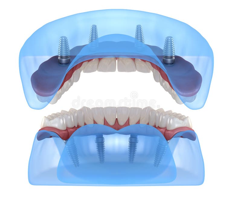Maxillary and Mandibular Prosthesis with Gum All on 4 System Supported ...