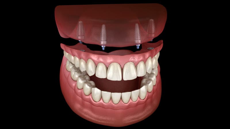 Maxillary Prosthesis Supported by Zygomatic Implants. Medically ...