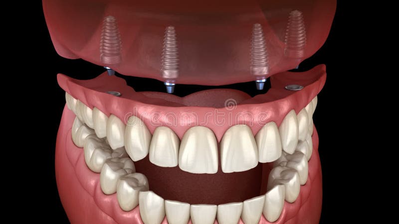 Maxillary Prosthesis Supported by Zygomatic Implants. Medically ...
