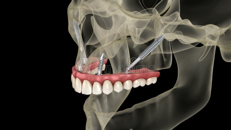 Mandibular Prosthesis All on 4 System Supported by Implants. Medically ...