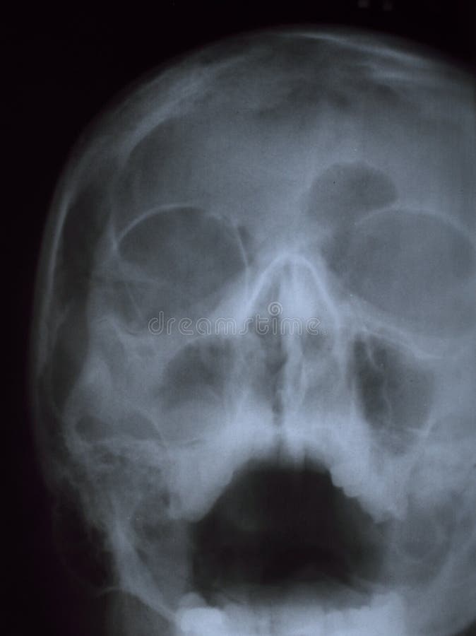 Maxillary Sinus with Cyst RH Stock Photo - Image of medicine, face ...