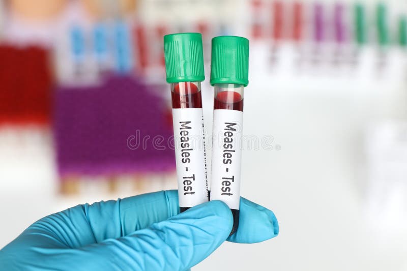 Measles Test, Blood Sample To Analyze in the Laboratory Stock Photo ...