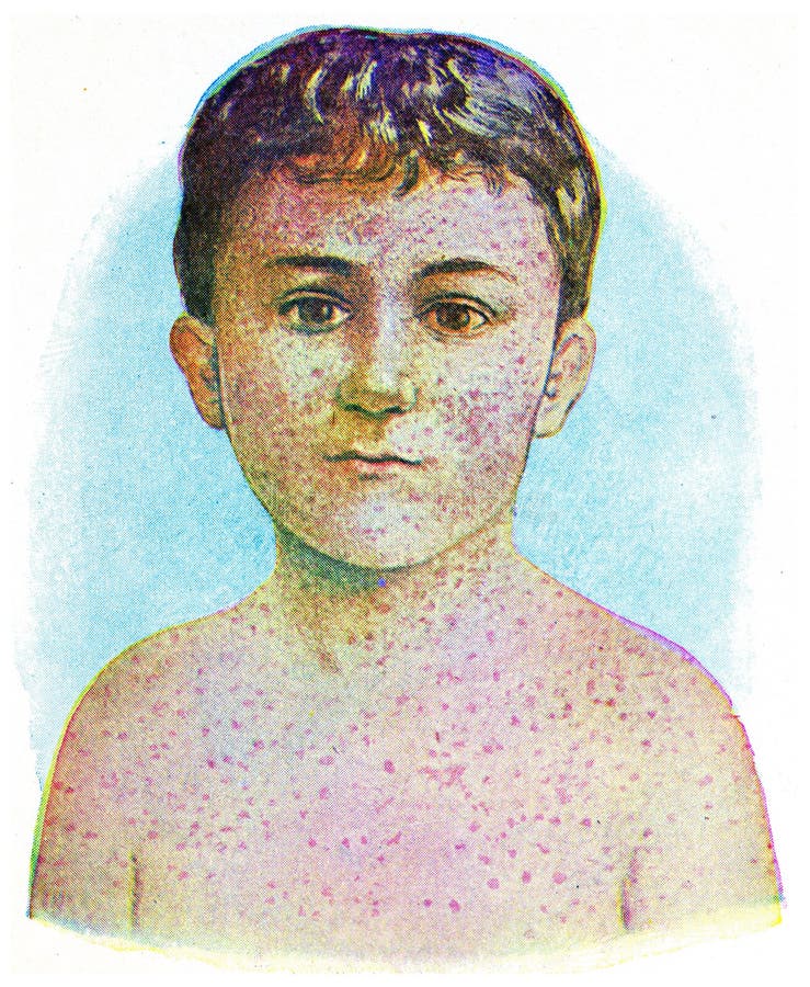 Measles Drawing Stock Illustrations – 150 Measles Drawing Stock ...