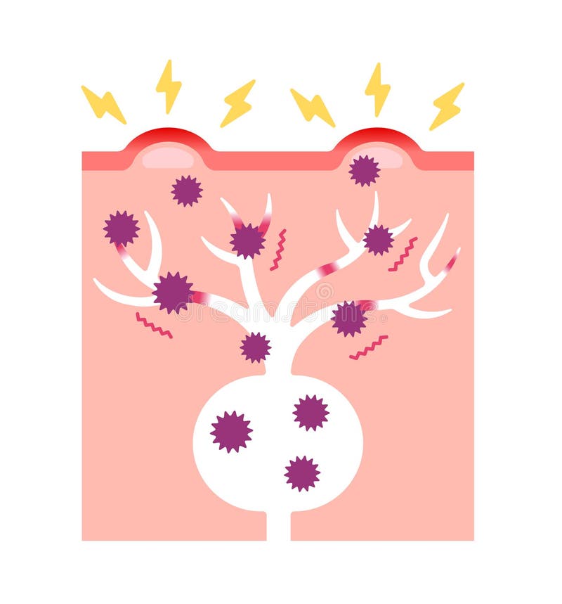 Mechanism of Shingles ( Herpes Zoster ) Vector Illustration Stock ...