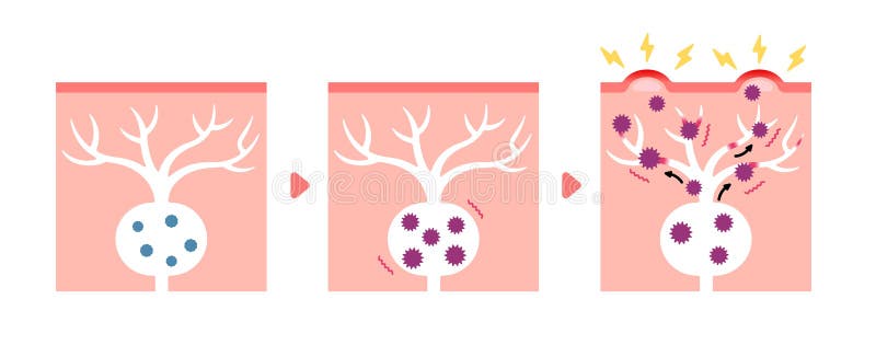 Shingles Virus Vector Stock Illustrations – 188 Shingles Virus Vector ...