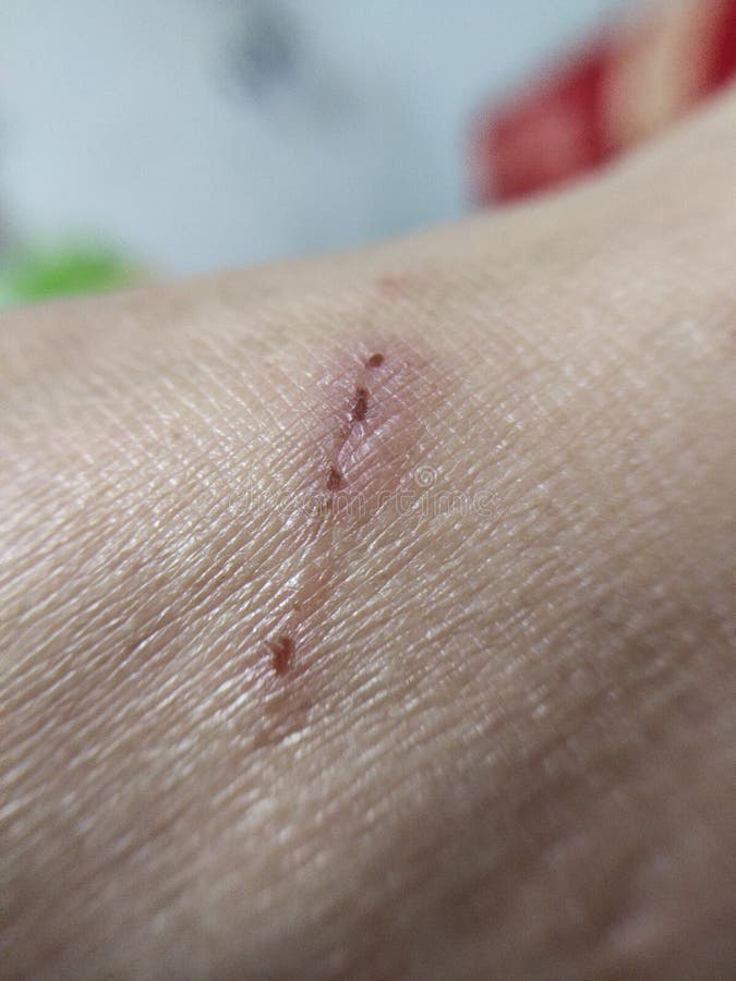 Scars on human skin stock image. Image of closeup, person - 209844697