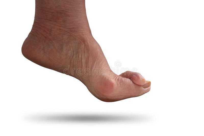 Medecin, Valgus Bunion, Leg with Deformation Valgus Hallux Bunion ...