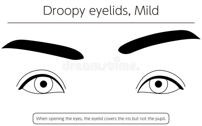 Eye Drooping Stock Illustrations – 107 Eye Drooping Stock Illustrations ...