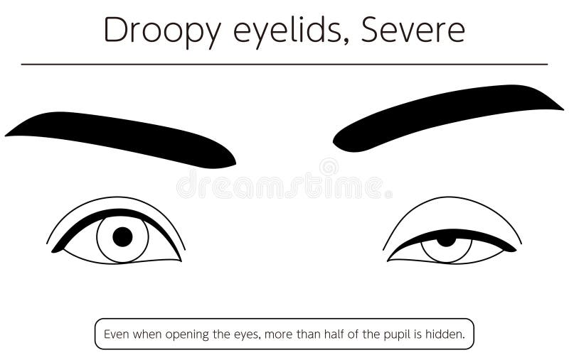 Medical Illustration: Diagram of Severe Ptosis (eyelid Drooping Stock ...
