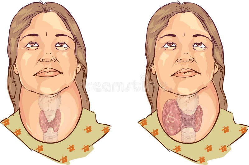 Medical Illustration of Goiter Stock Vector - Illustration of body ...