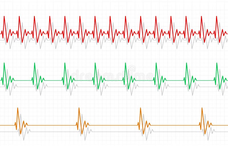 Fast Normal Slow Heartbeat Illustration Stock Illustration ...