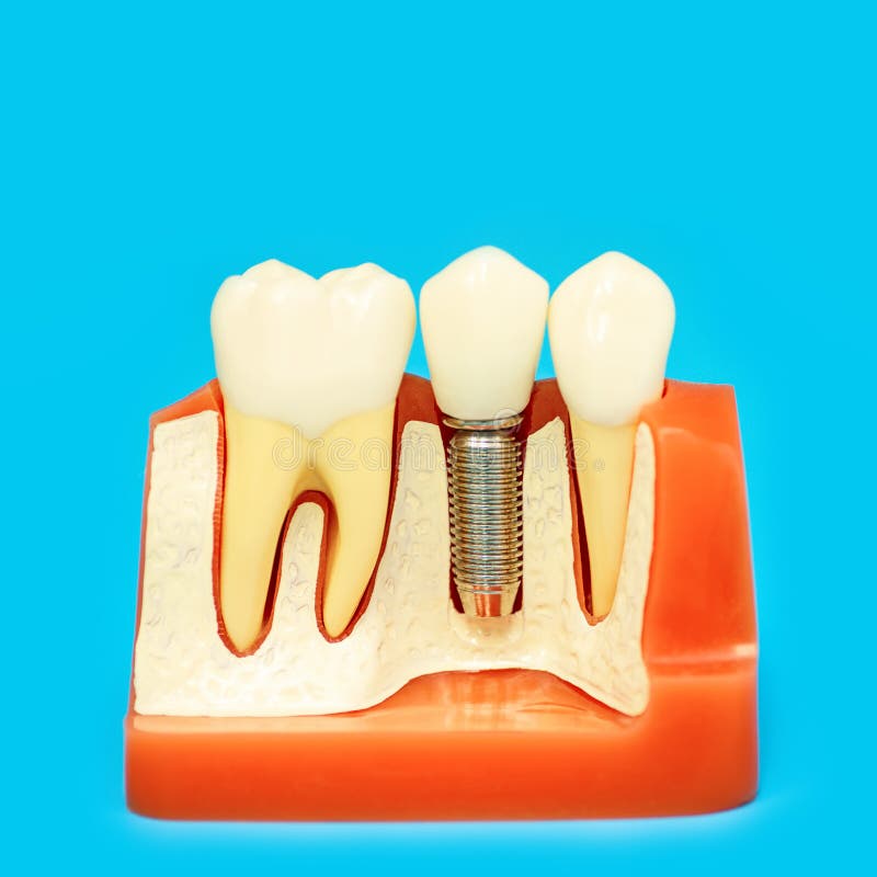 Medical Model of the Jaw with False Teeth on a Pin on Blue Background ...