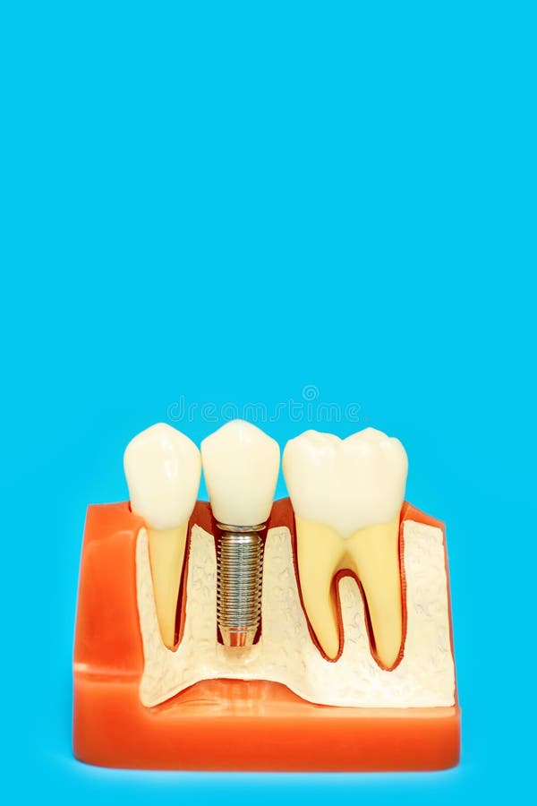 Medical Model of the Jaw with False Teeth on a Pin on Blue Background ...