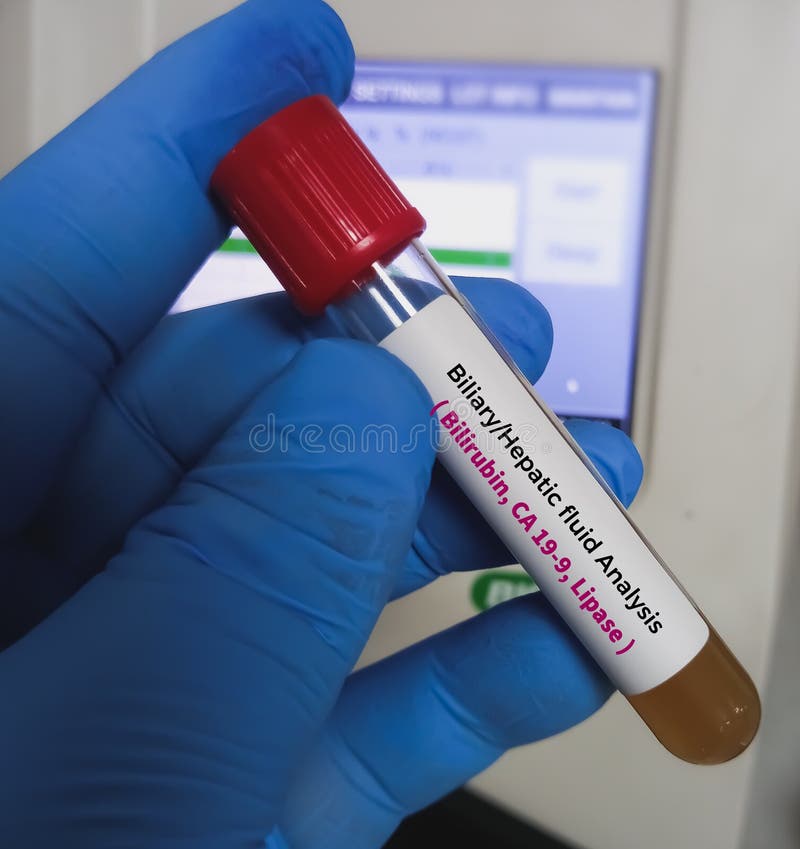 Medical Technologist Hold Peritoneal Fluid Sample for Peritoneal Fluid ...