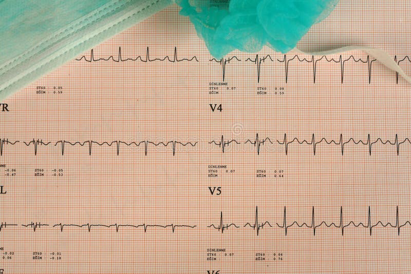 Obstructive Sleep Apnea Symptom Chart from Sleep Test for Doctor To ...