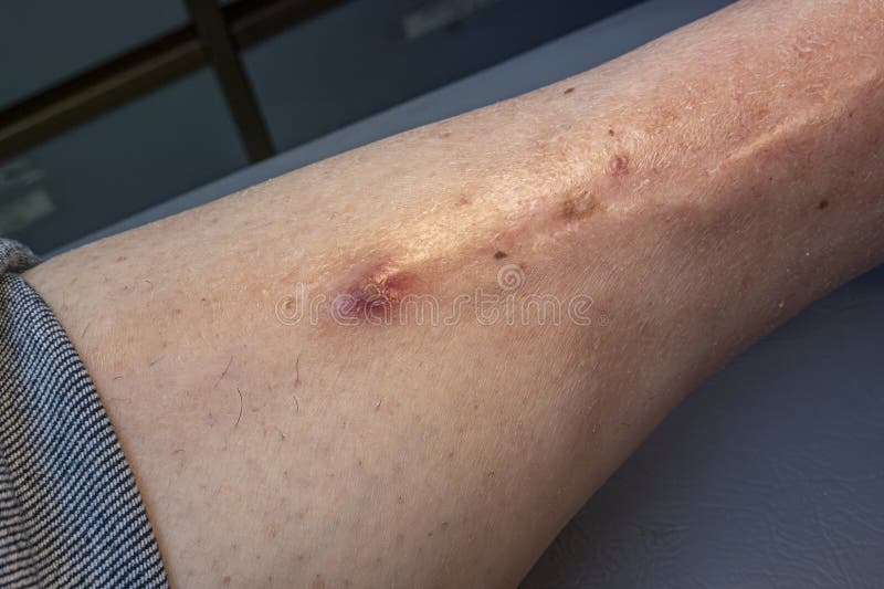 Female Patient with Calcinosis and Scleroderma Stock Photo - Image of ...