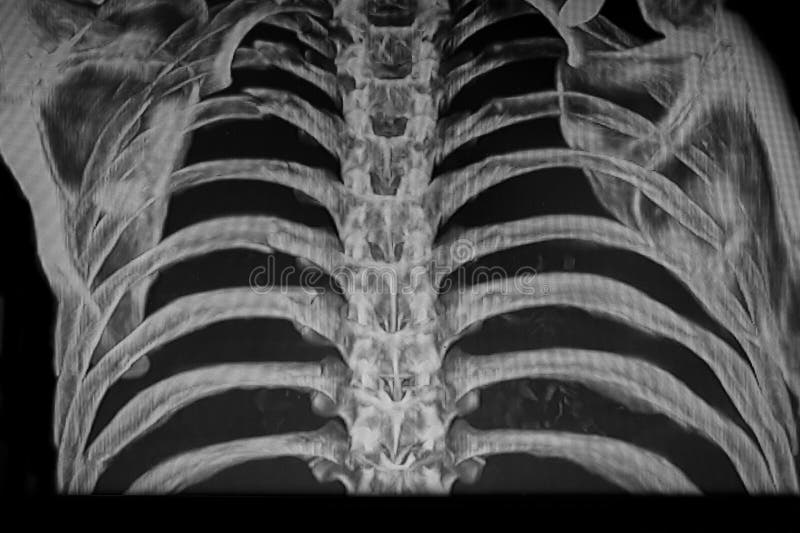 Chest X- Ray that Shows Broken Ribs Stock Photo - Image of organ ...