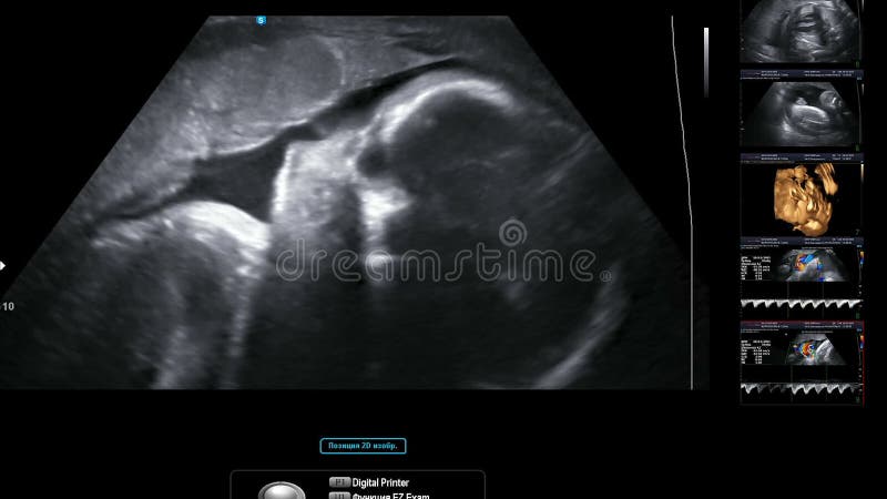 Medical Ultrasound Screening Stock Video - Video of scanner, baby ...
