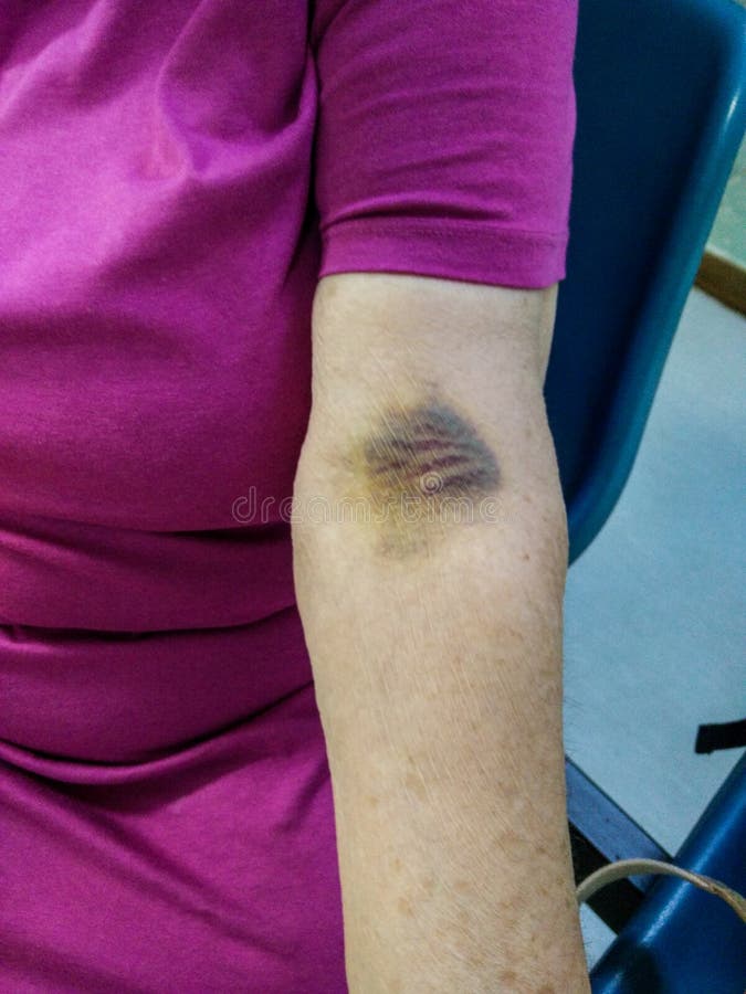 Hematoma Grande En El Brazo Humano Foto de archivo - Imagen de sangre ... Hematoma Grande En El Brazo Humano Foto de archivo - Imagen de sangre ...