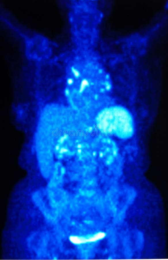 Medicina Nuclear De Pet/ct Imagen. Imagen: 31198398