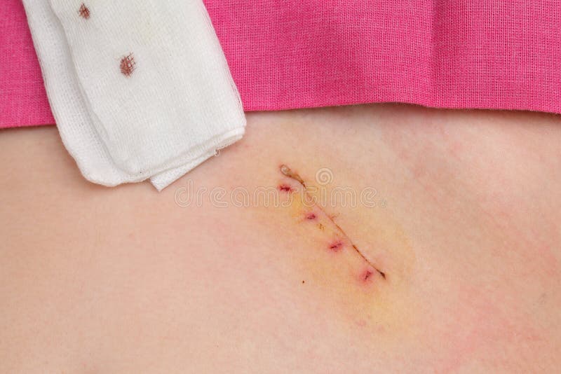 Medicine, Appendectomy Surgery Scar Stock Image - Image of anatomy ...