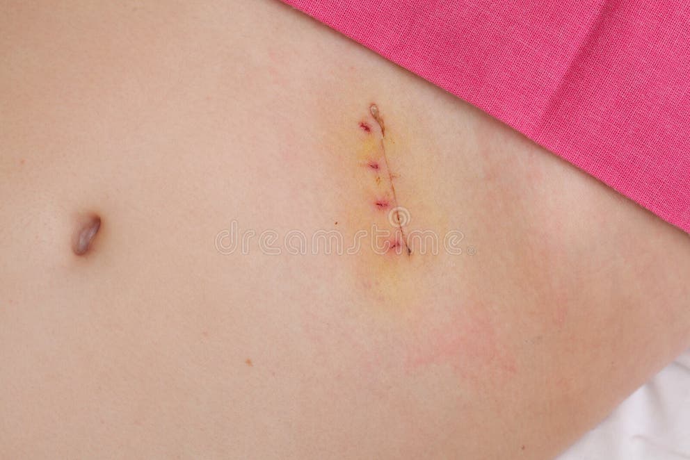 Medicine, Appendectomy Surgery Scar Stock Photo - Image of injury ...