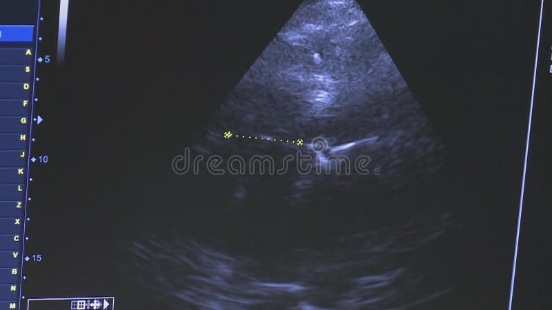 Medizinischer Ultraschallscan-Herz Echocardiogram Stock Footage - Video ...