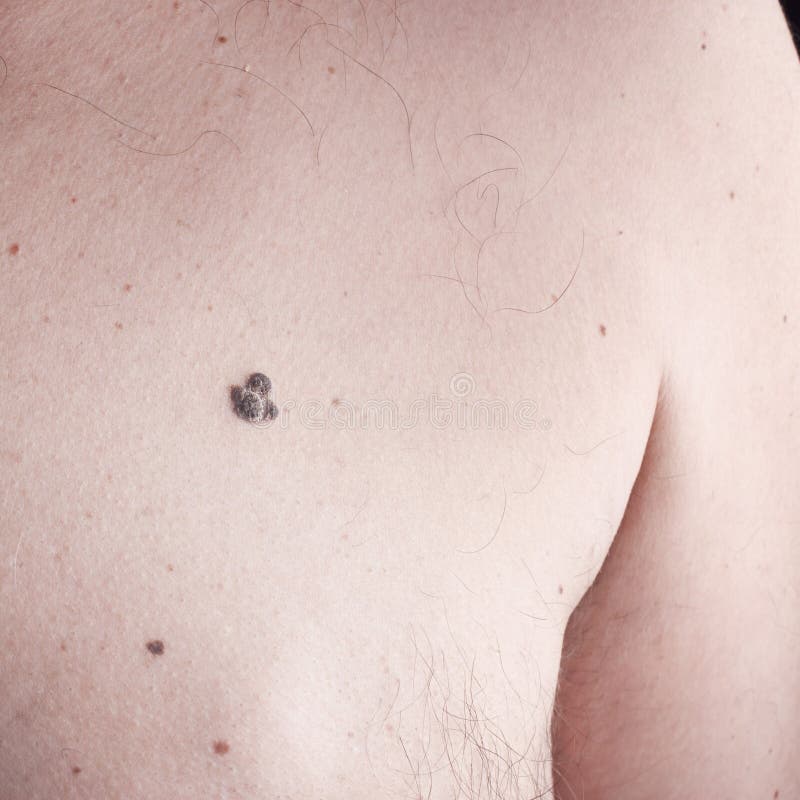 Mole - Nevus stock photo. Image of healthy, bristle, hairy - 23916744