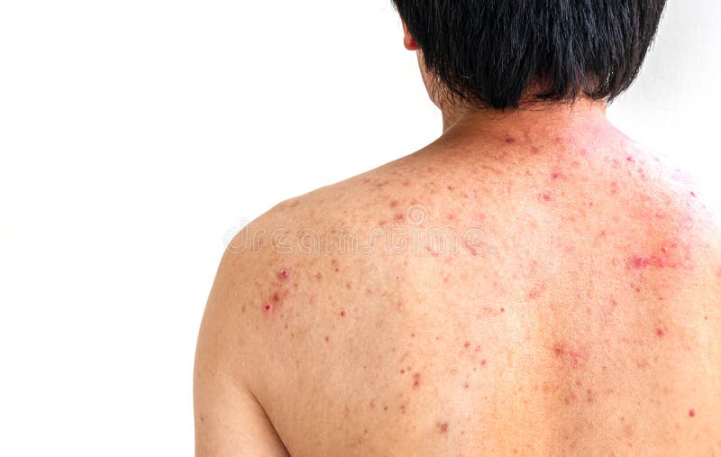 Men with Acne, with Red Spots on the Back Stock Image - Image of ...