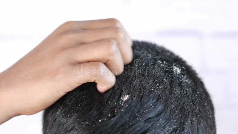 Men with Dandruff on Hair Close Up Stock Footage - Video of shampoo ...