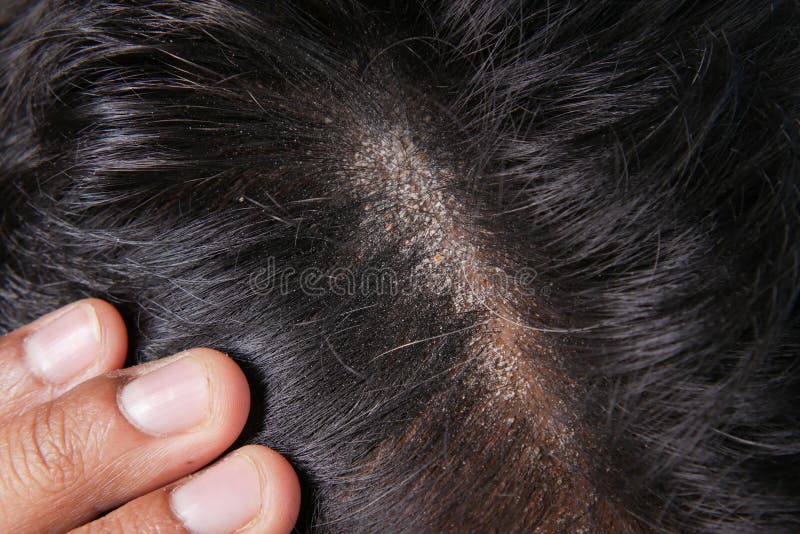 Men with Dandruff in His Hair, Closeup Stock Photo - Image of medical ...