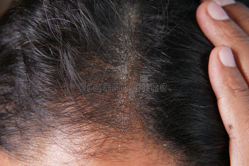 Men with Dandruff in His Hair, Closeup Stock Photo - Image of messy ...