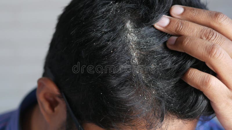 Men with Dandruff in His Hair, Closeup Stock Video - Video of flake ...