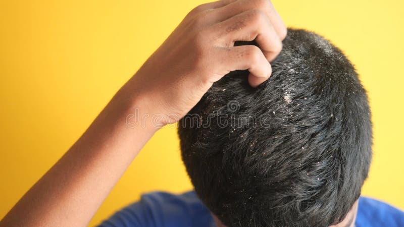 Men with Dandruff in His Hair, Closeup Stock Video - Video of itchy ...