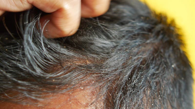 Men with Dandruff in His Hair, Closeup Stock Video - Video of health ...