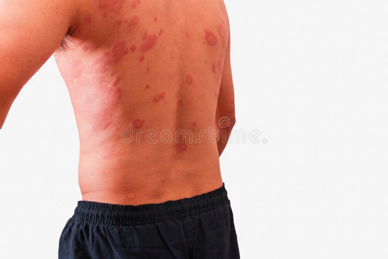Men with Dermatitis Problem of Rash ,Allergy Stock Photo - Image of ...