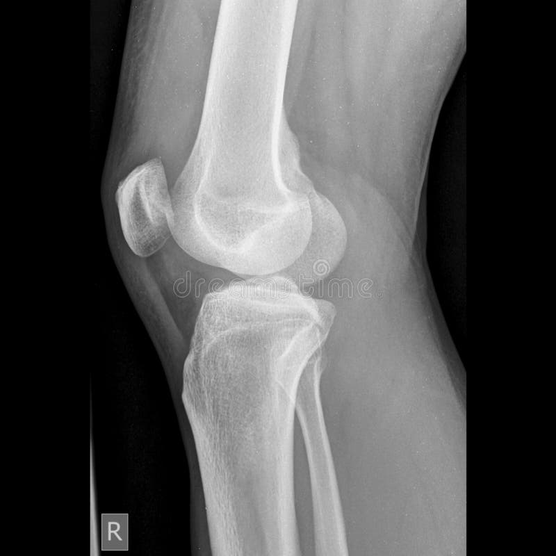 Knee Joint X Ray Image Lateral View Stock Photo - Image of pain ...