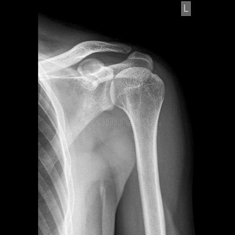 Shoulder Joint X-ray Image AP View Stock Image - Image of hand ...