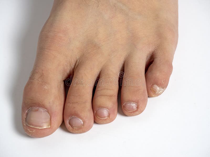 Men`s Foot Problems on the Skin and on the Nails Stock Photo - Image of ...