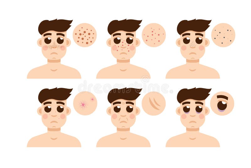 Men skin problem. Acne men stock vector. Illustration of cracking ...