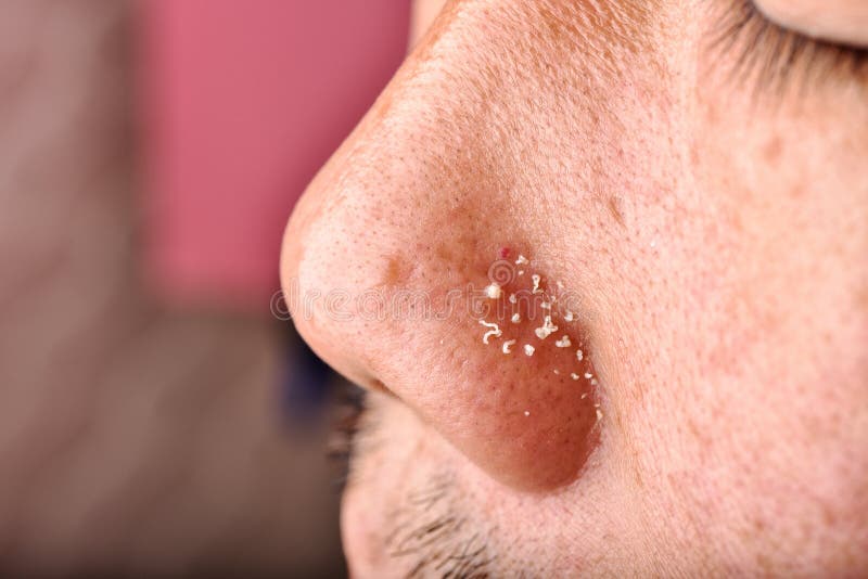 Men Skin Problem Acne Squeeze Whitehead Comedone Pus Extraction