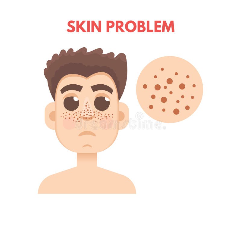 Men Skin Problem. Facial Care Stock Vector - Illustration of healthy ...