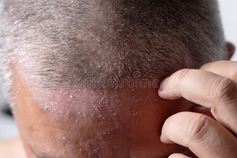 Men are Using His Hands To Scratch the Head Ulcers Stock Photo - Image ...