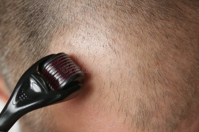 Men Using Microneedle Derma Roller on Head for Stimulating New Hair ...