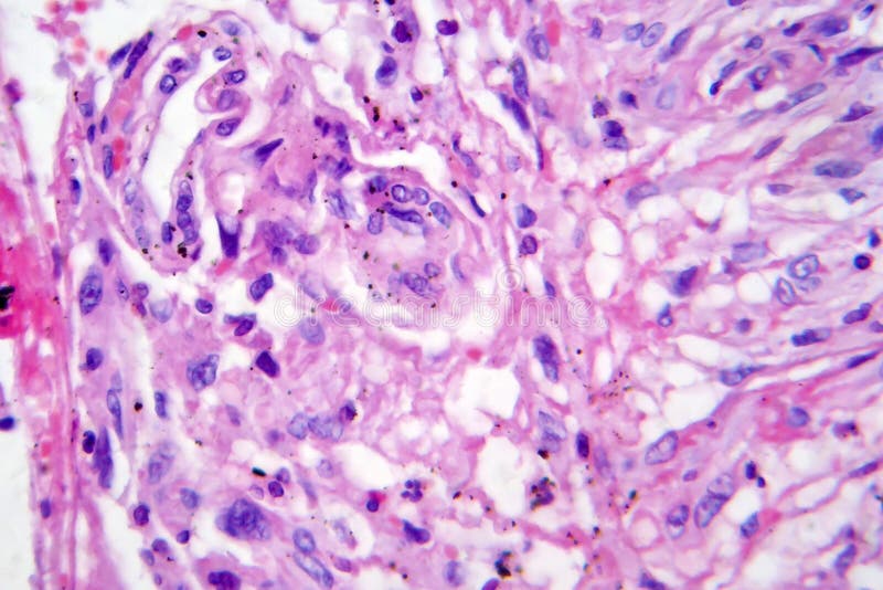 Meningioma, Light Micrograph, Photo Under Microscope Stock Photo ...