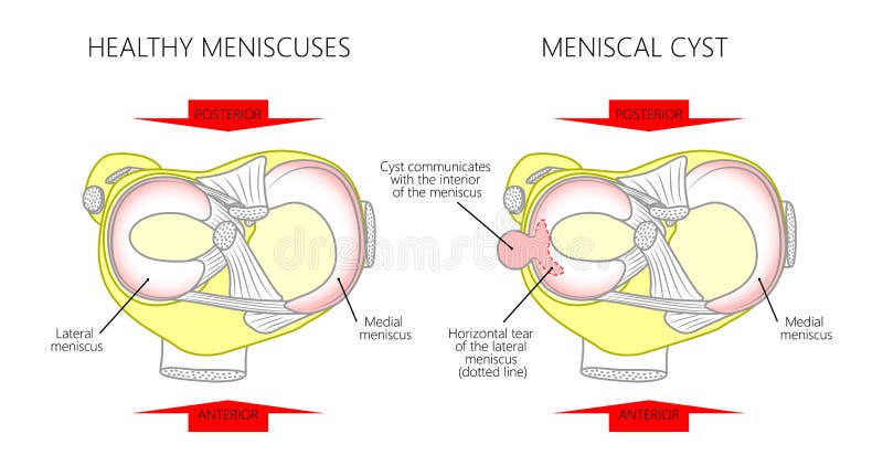 Menisk Stock Illustrationer, Vektorer, & Clipart – (2,304 Stock ...