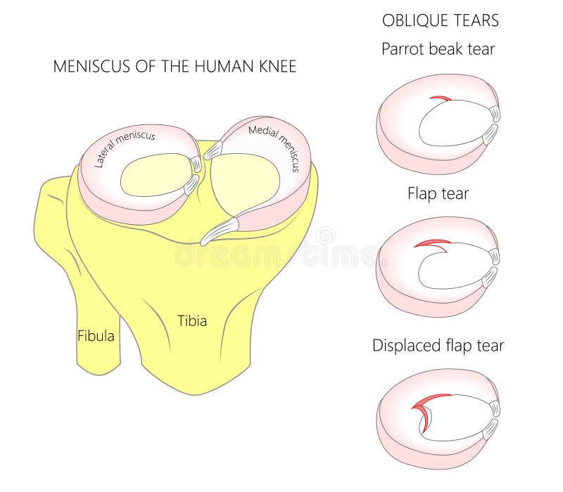 Menisk Stock Illustrationer, Vektorer, & Clipart – (2,629 Stock ...