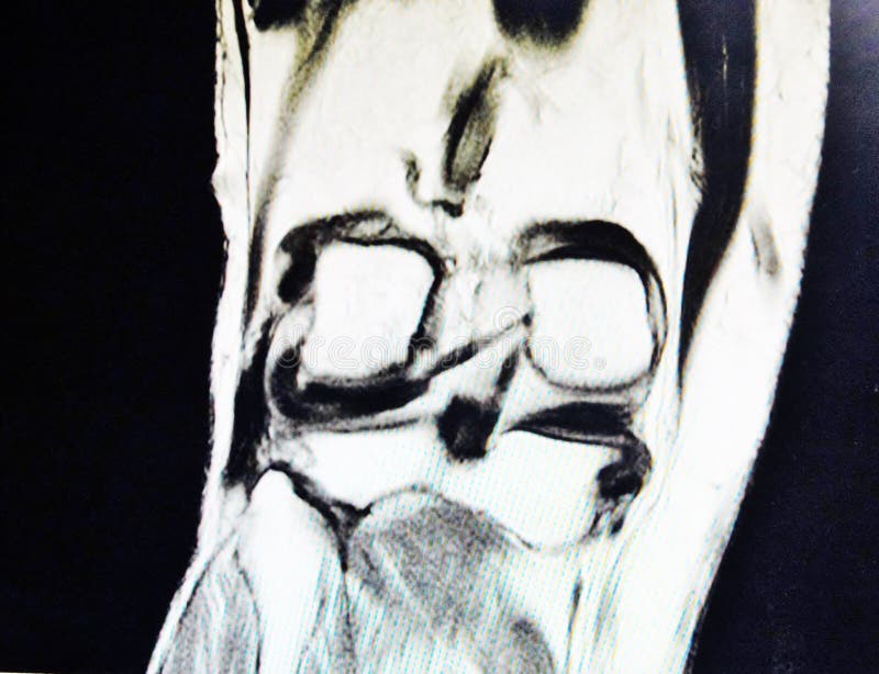 Meniskus-Risspathologie Mri Seitliche Stockfoto - Bild von ...