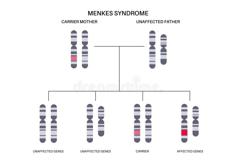 Menkes syndrome poster stock vector. Illustration of disease - 319426313